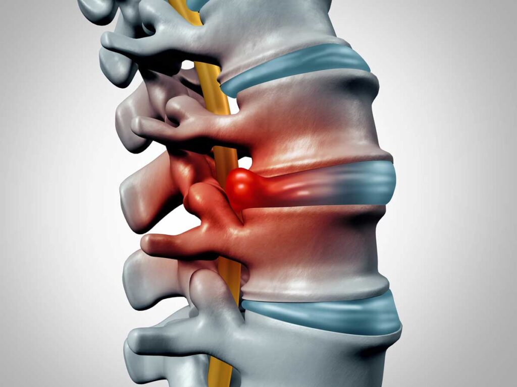 Disc Problems – Leitner Chiropractic and Massage Therapy